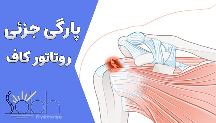 پارگی روتاتور کاف در شانه چیست؟ - هوم ویزیت تهران